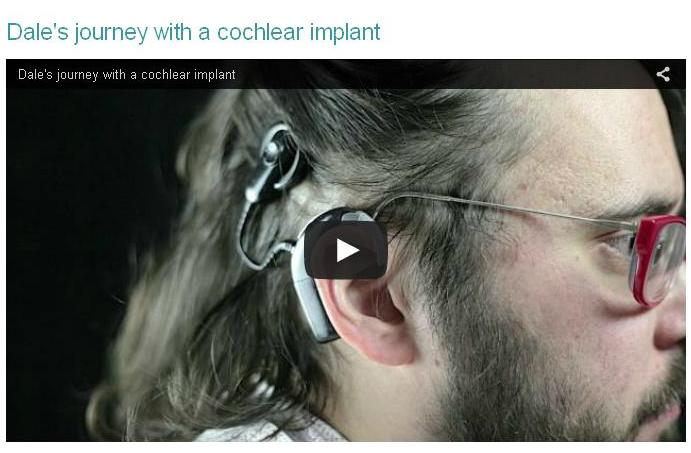 Living with a hearing implant – new patient films now available | Guy's ...